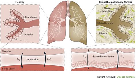 Interstitial Lung Disease A Review Of Classification Etiology