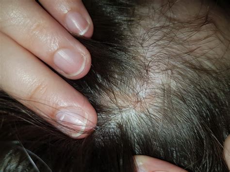 Weird Scalp Lump Rdermatologyquestions