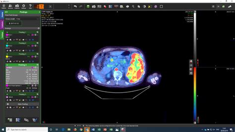 Ai Based Multi Organ Segmentation Of Healthy Tissue Metabolism In Pet Ct Imaging For Cancer