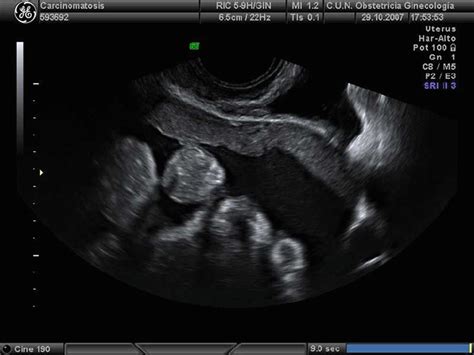 Transvaginal Ultrasound Showing Carcinomatosis Involving The Peritoneum
