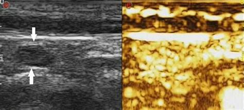 A Small Lymph Node Outlined By Arrows Spotted In Level Ib On B Mode