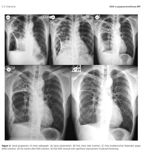 Chest Radiograph In Pyopneumothorax Patients With Pneumonia Sze