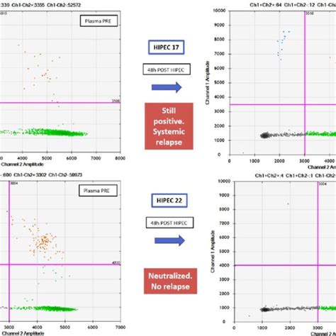 Frequent And Complex Interplay Between Kras And Gnas In Mnas A High