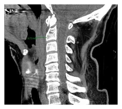 Midsagittal CT Soft Tissue Window Demonstrating Prevertebral Soft
