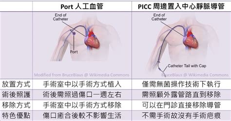 化療管路怎麼選？ Port、picc特點比一比 照護線上