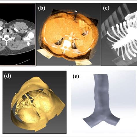 A Raw Ct Image And Cross Sectional View B Cross Sectional View