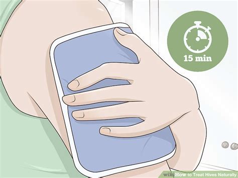 3 Ways To Treat Hives Naturally Wikihow