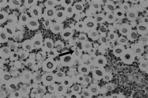 Left Dorsal Cerebral Cortex Aggregates Of Cryptococcal Yeasts