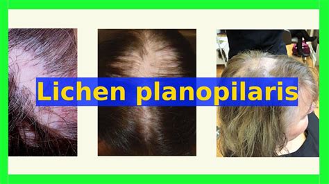 Lichen Planus Scalp Treatment