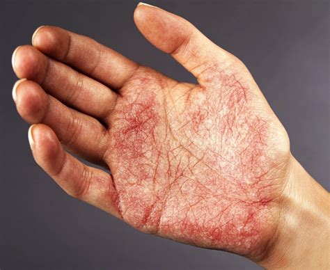 Tinea Manuum Md Searchlight
