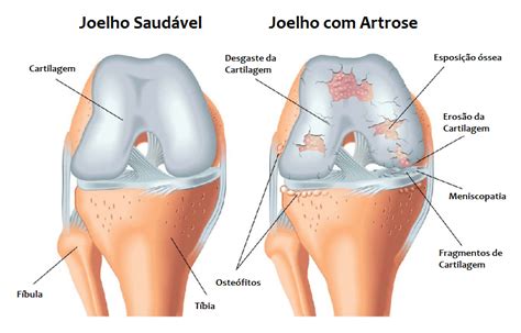 Artrose no joelho Educar Saúde