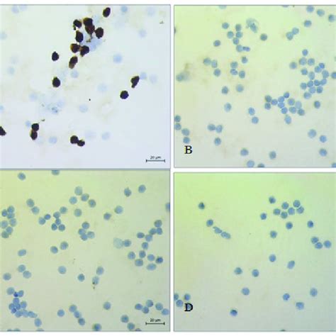 Reactive Mesothelial Cells Of Cirrhosis In Peritoneal Effusion A