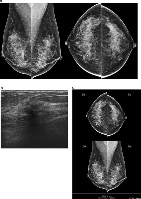 Artificial Intelligence Based Computer Assisted Detection Diagnosis Ai