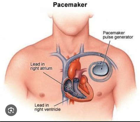 Sanjeev Kumar संजीव कुमार On Linkedin Can Pacemakers Battery Be