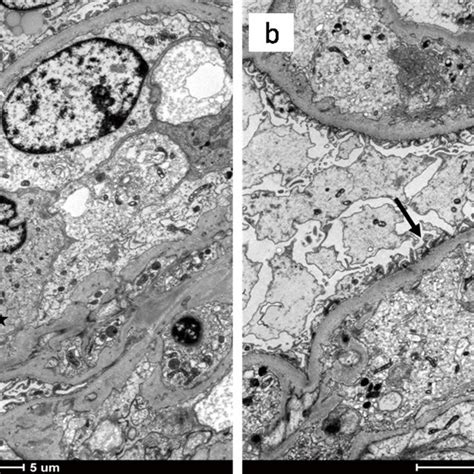 Electron Microscopy Of Diffused Foot Process Effacement Indicated By Download Scientific
