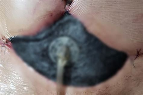 Se Hizo Una Liposucción En Colombia Y Terminó Con Gangrena En El