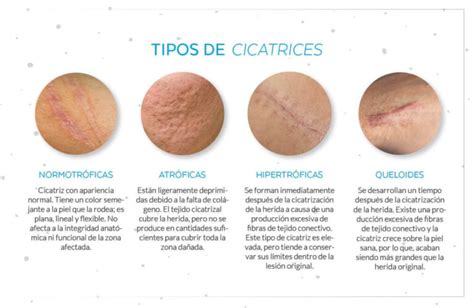 Tipos De Cicatrización • Tiposde