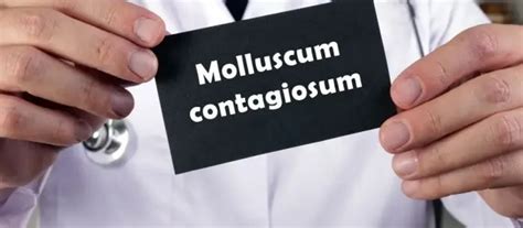 A Dermatologists Guide To Molluscum Contagiosum Craig Singer Md