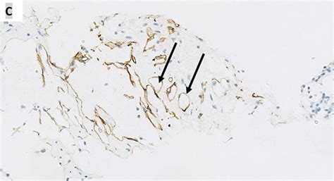 Unusually Hypervascularized Liver Lesion Journal Of The Belgian