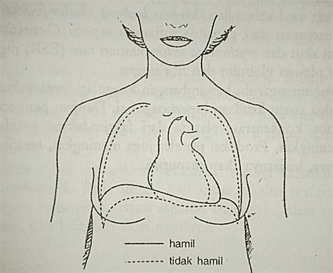 Perubahan Anatomi Pada Ibu Hamil Tulisan