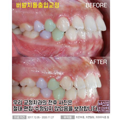 비발치 돌출입 교정 비발치교정 돌출입교정 Before 미국 교정 전문의 부산 뉴욕스마일 치과