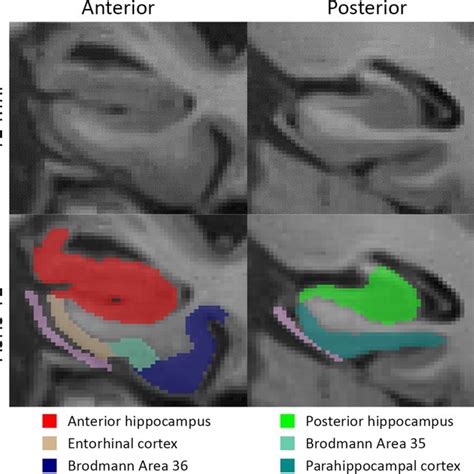 Example Of An Automated Segmentation Of Medial Temporal Subregions Download Scientific Diagram