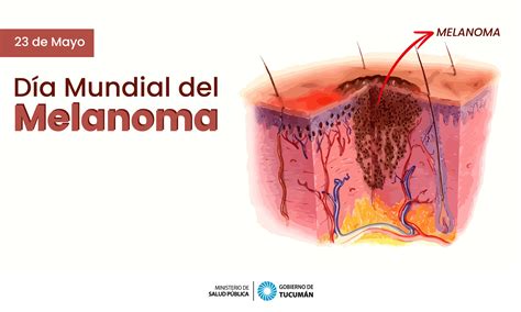 Día Mundial Del Melanoma 2022 Ministerio De Salud Pública De Tucumán