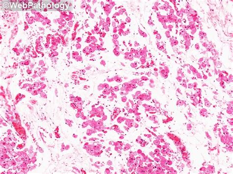 Hibernoma Microscopic Features