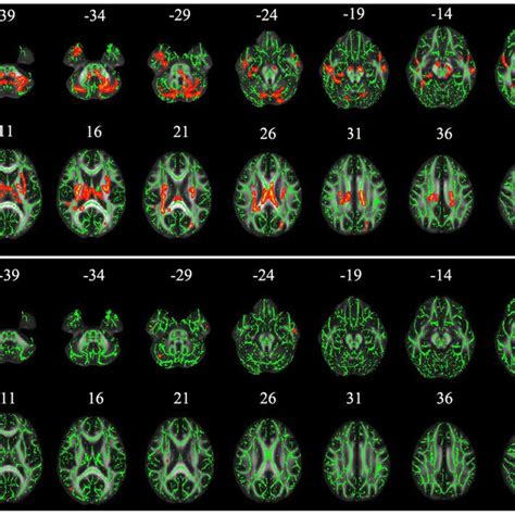 Statistical Maps Of Group Comparison Of Fractional Anisotropy FA