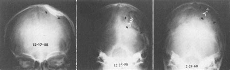 Compound Skull Fracture