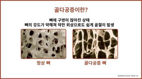 노인 골절 부르는 골다공증 ‘꾸준한 치료가 가장 중요 당신의 건강가이드 헬스조선