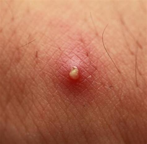 Pimple On The Penis Causes Symptoms And Treatment