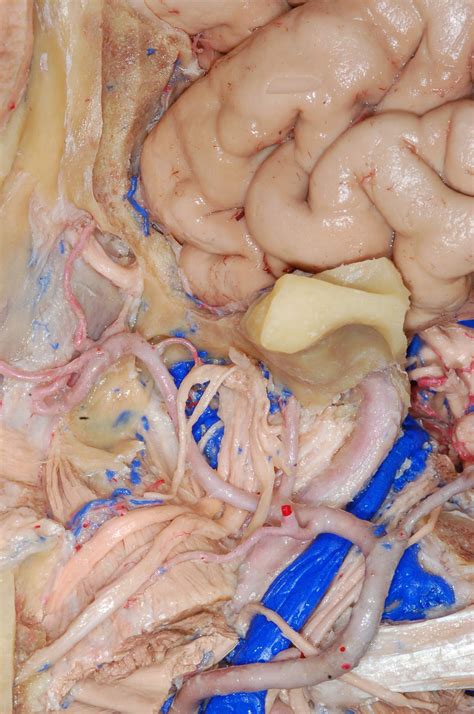 Deep View Of Left Infratemporal Fossa Temporal Lobe And Deep Neck Structures Neuroanatomy
