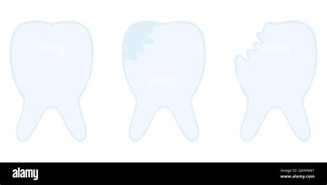 Molaire Saine Dent Malade Avec Caries Et Cassée Ensemble D