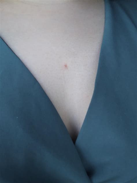 Sternum Piercing Scar