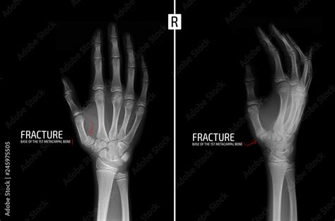 1st Metacarpal