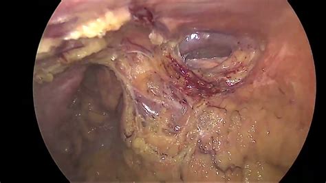 Laparoscopic Reconstituting Subtotal Cholecystectomy Youtube