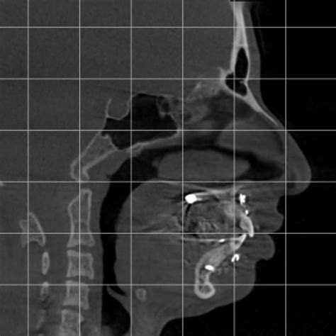 Casper The Next Generation Of Class Ii Correction Odl