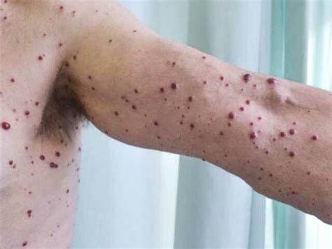 Bacillary Angiomatosis Bartonella Pathology Of Bartonellosis Or