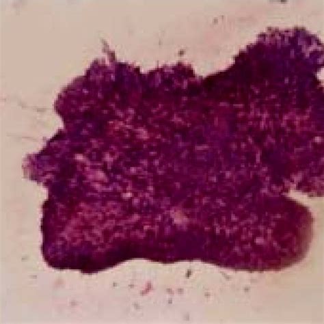 Basaloid Cells In Nests With Peripheral Palisading H And E X400