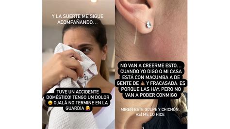 El Impresionante Accidente Doméstico De Cinthia Fernández Tengo Un