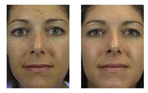 Facial Rejuvenation Treatments From Ohio Plastic Surgery Specialists