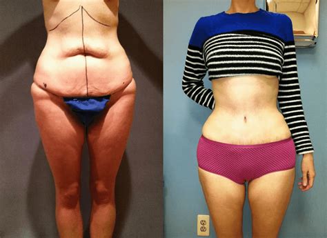 Tummy Tuck Services Rejuv Cosmetic Surgical Center