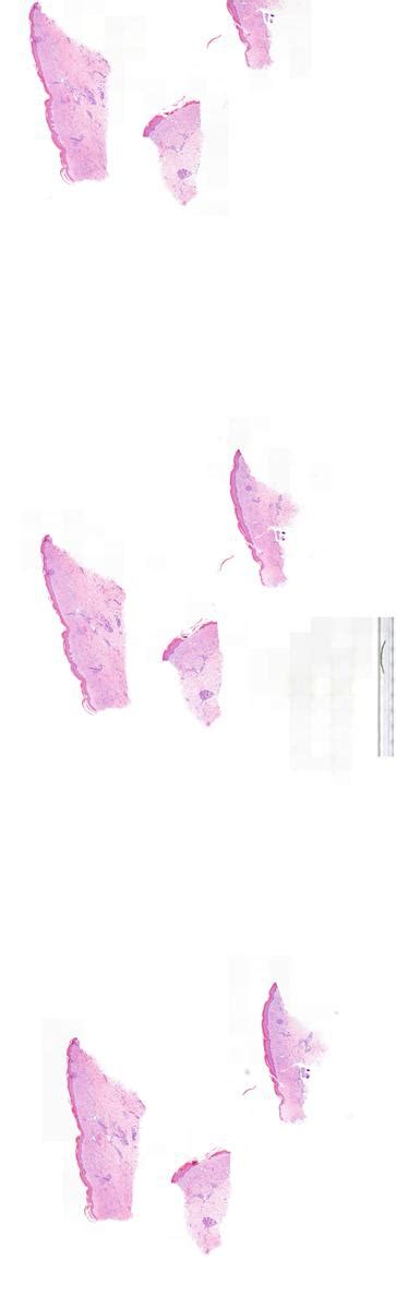 Diffuse Dermal Angiomatosis Kiko Xp