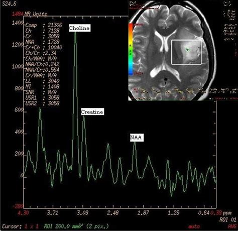 Mr Spectroscopy Radiology Reference Article Radiology Radiology Imaging