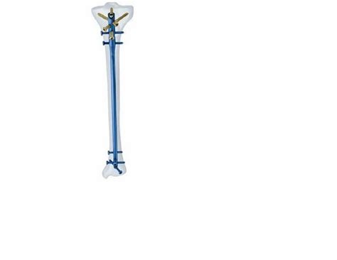 Titanium Interlocking Expert Tibial Nail At Rs 3000 In New Delhi Id