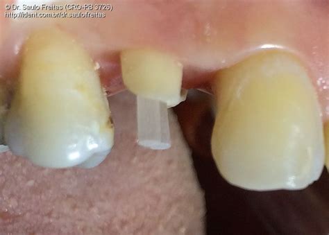 Coroa Metalo Cerâmica Núcleo de Fibra de Vidro Caso clínico iDent