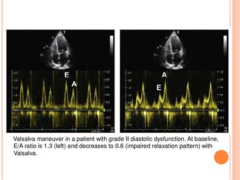 Diastolic Dysfunction 2016