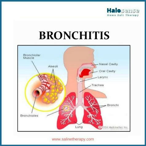 Pin On Bronchitis