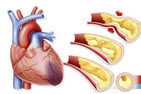 高血压患者喝咖啡，到底好不好？ 知乎
